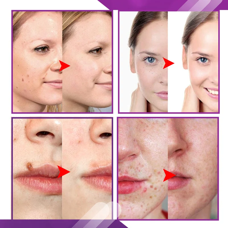 Organic Skin Tag Removal Serum - JDGOSHOP - Creative Gifts, Funny ...