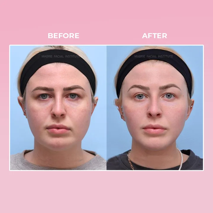 ShapeZ™🌲 V Face Suction Trainer