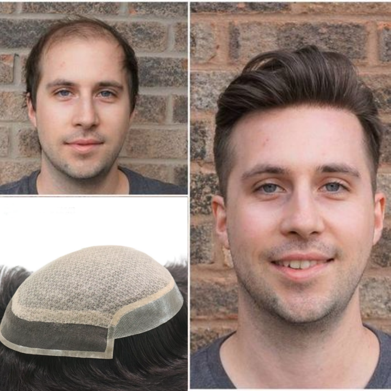 Hair Prosthesis Injection Skin Toupee