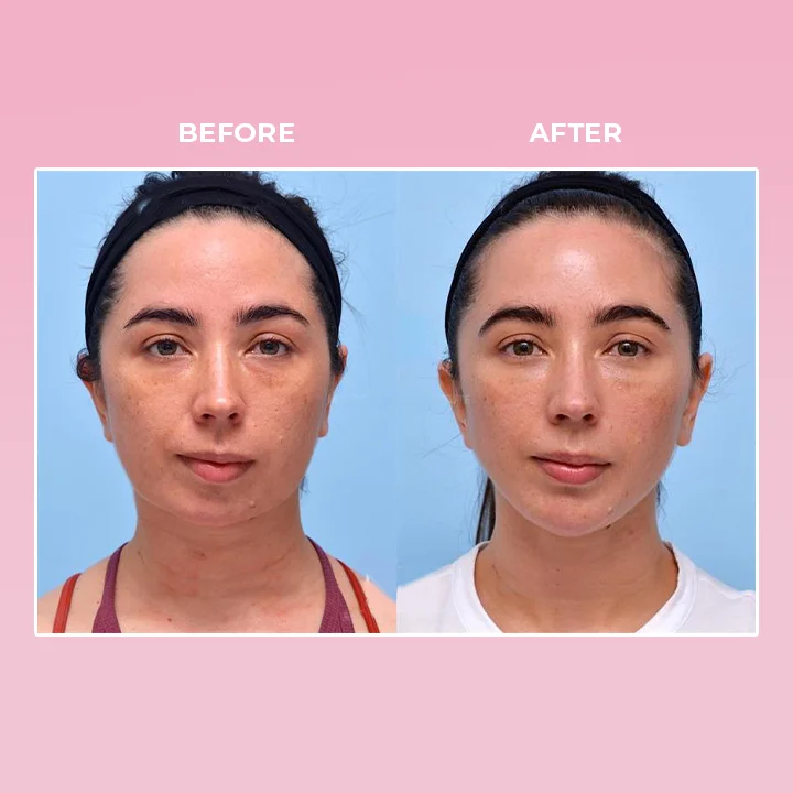 ShapeZ™🌲 V Face Suction Trainer