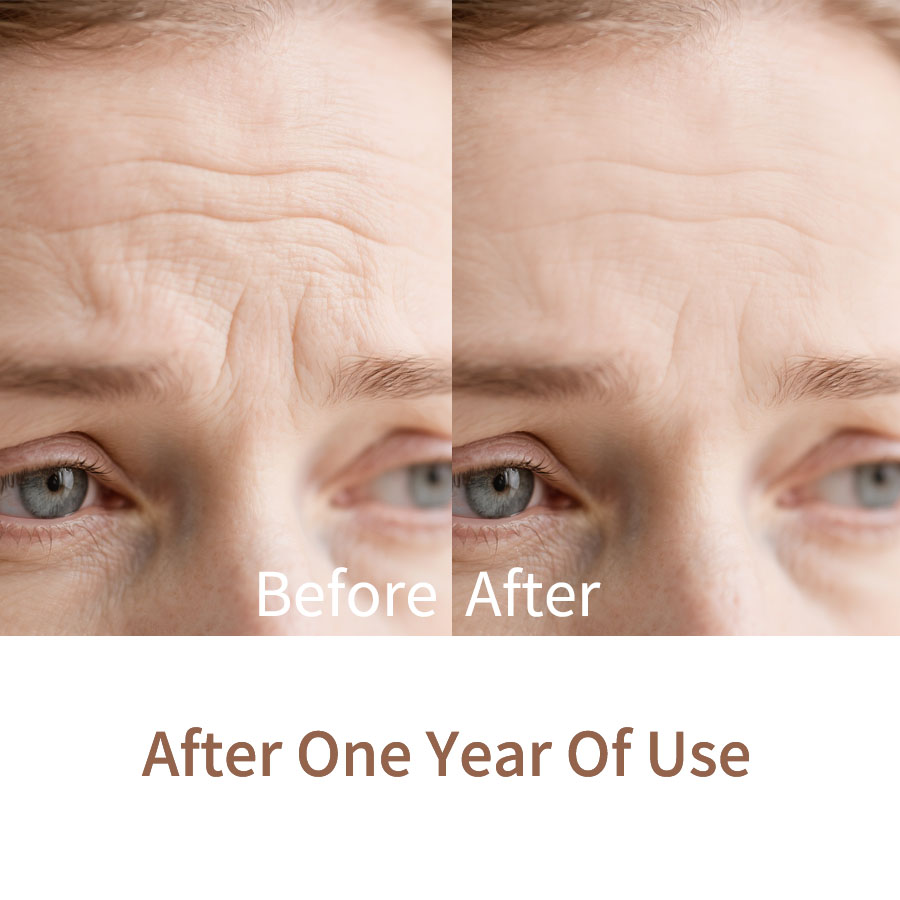 Forehead Before & After Use